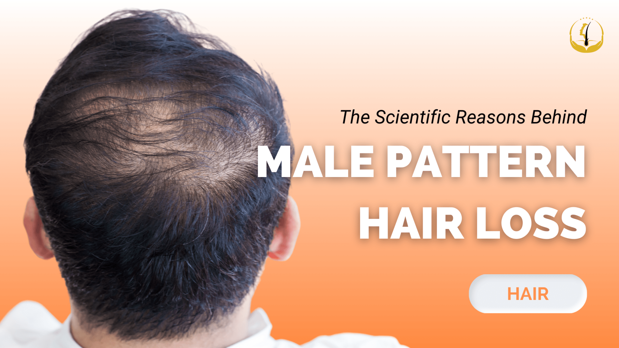 The Scientific Reasons Behind Male Pattern Hair Loss | GLOJAS