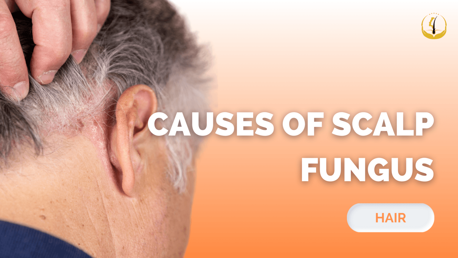 Causes Of Scalp Fungus - Hair Transplant Glojas