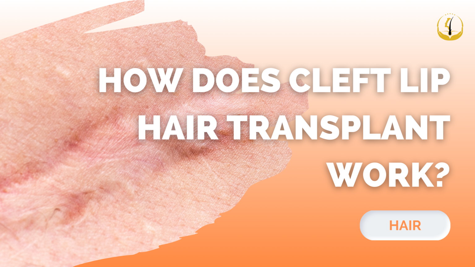 How Does Cleft Lip Hair Transplant Work?