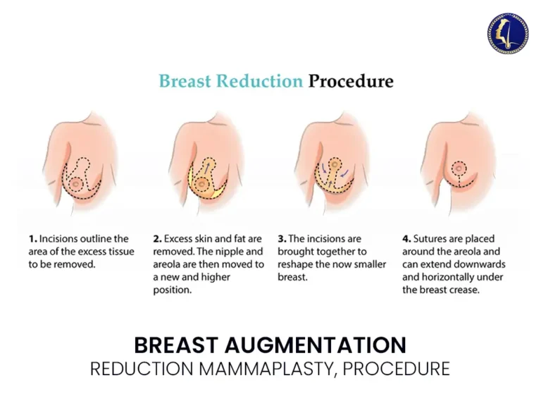 Breast Reduction Surgery Reduction Mammaplasty Malaysia Breast Reduction Surgery Reduction Mammaplasty Malaysia