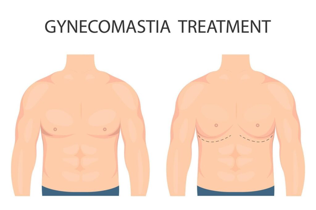 Gynecomastia Surgery Malaysia | Male Breast Reduction Expert