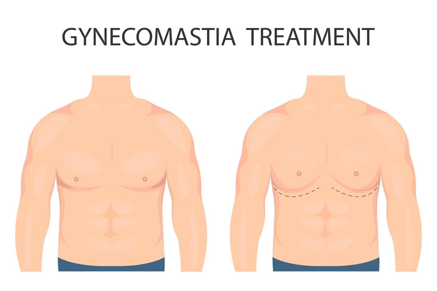 Gynecomastia Surgery Malaysia | Male Breast Reduction Expert