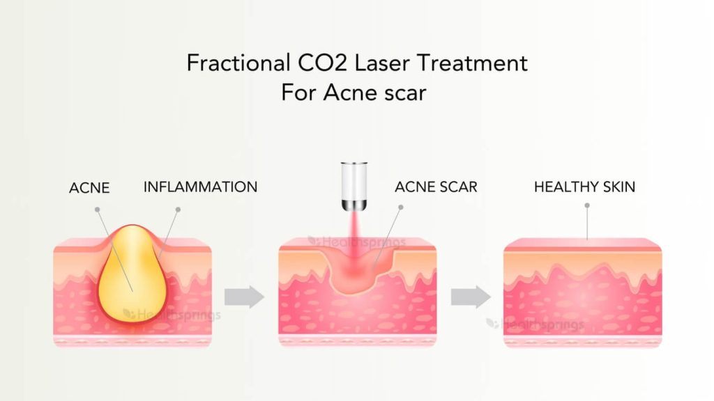 Fractional CO2 Laser | Effective Skin Resurfacing Malaysia