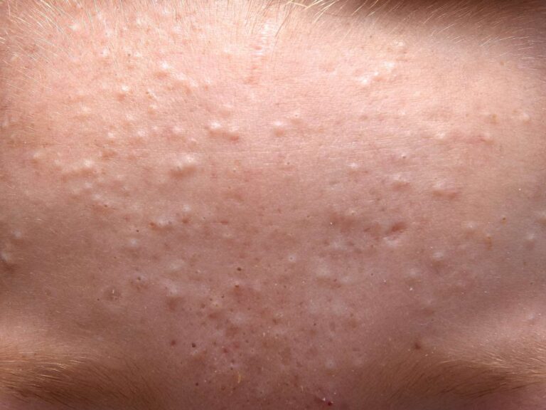 Tiny Bumps On Face: Causes, Types & Effective Treatments
