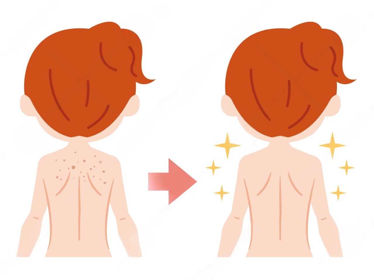 How To Get Rid Of Back Acne: Causes, Remedies & Expert Advice