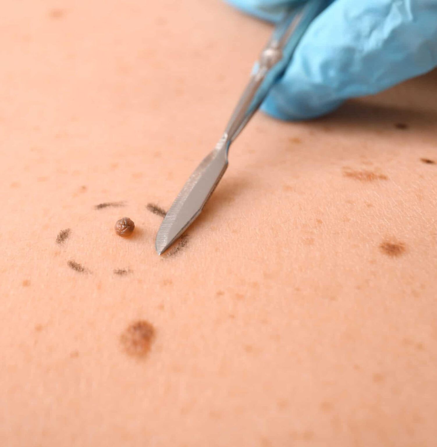 Safe & Effective Skin Tag Removal In Kuala Lumpur, Malaysia